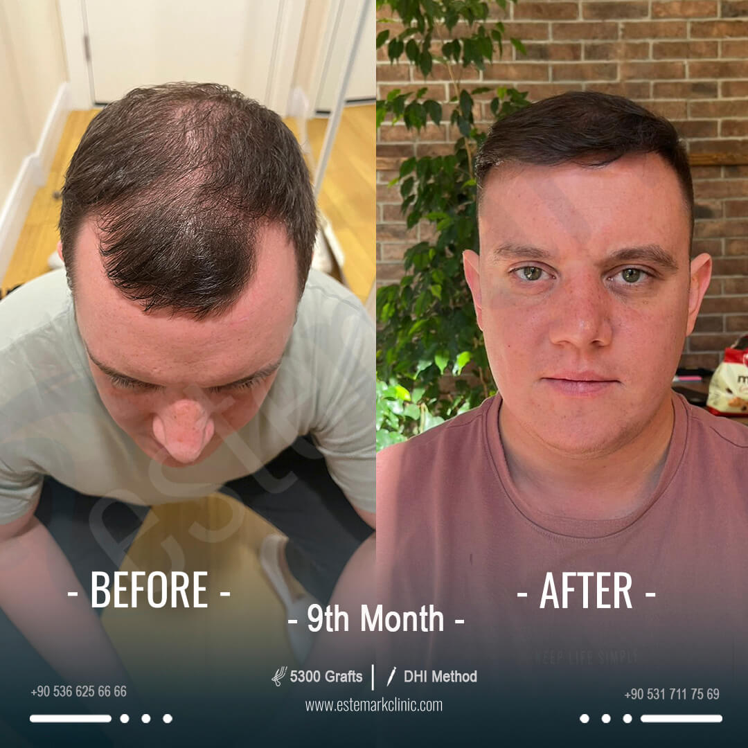 Turkey Hair Transplant - 6 Steps of Hair Transplant in Turkey